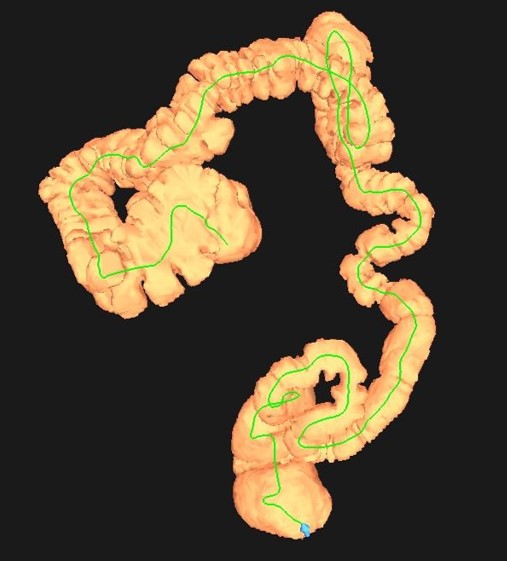 CT Colonography – Department of Radiology – UW–Madison